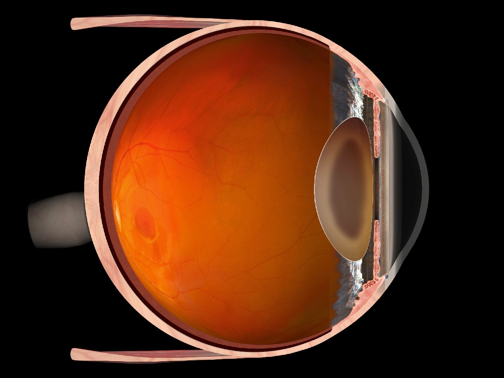 Nuclear Cataract
